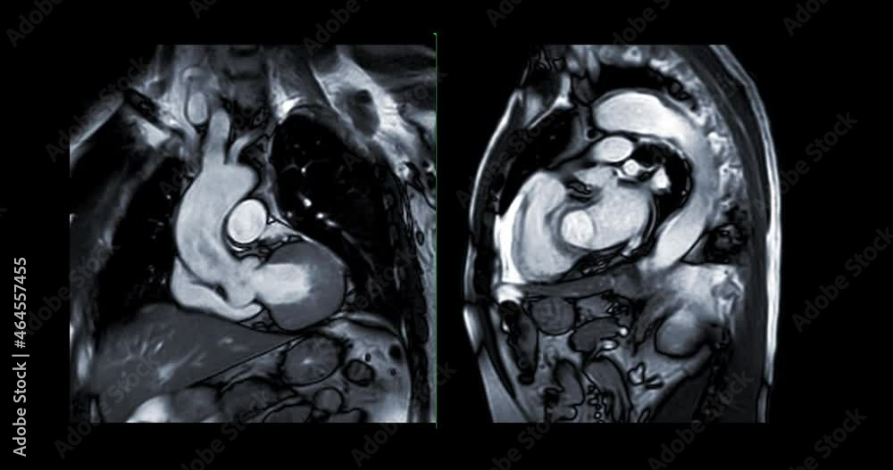 MRI heart or Cardiac MRI ( magnetic resonance imaging ) of heart in ...
