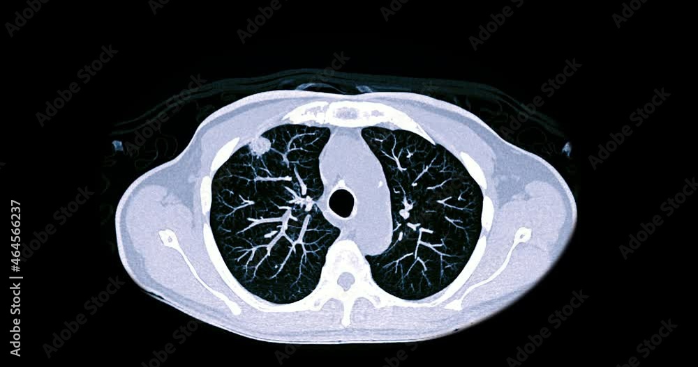 CT Chest or CT Lung axial mip view for diagnostic lung diseases and ...