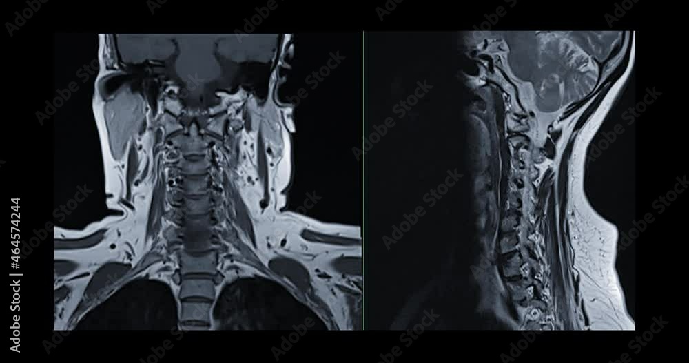 MRI C-spine or magnetic resonance image of cervical spine Axial ...