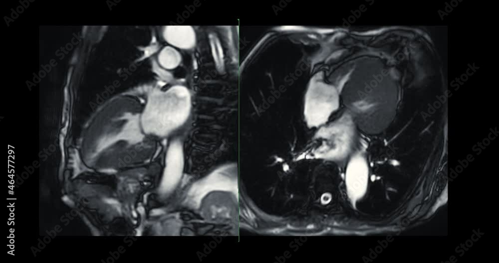 MRI heart or Cardiac MRI ( magnetic resonance imaging ) of heart in ...