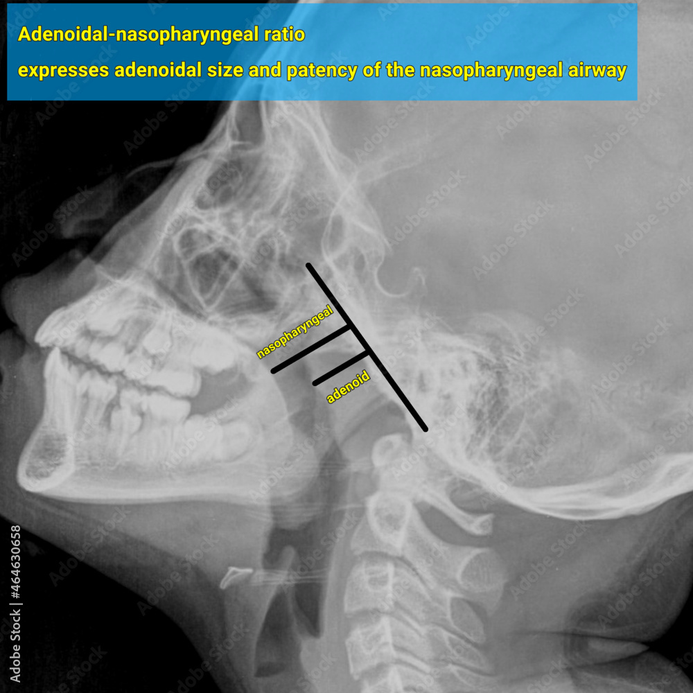 X ray of adenoid nasopharyngeal ratio Stock Vector | Adobe Stock X ray of adenoid nasopharyngeal ratio Stock Vector | Adobe Stock