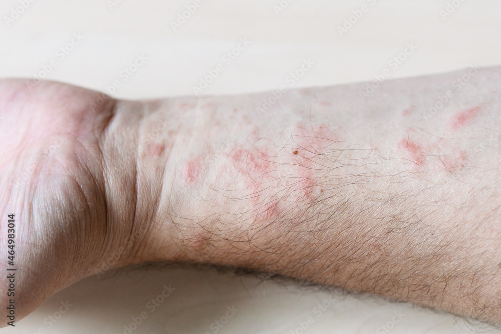 sample of Allergic contact dermatitis - rash on inner side of forearm close up Stock-Foto ...
