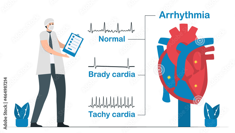 Normal heart signal is compared with 2 types of arrhythmia. It includes ...