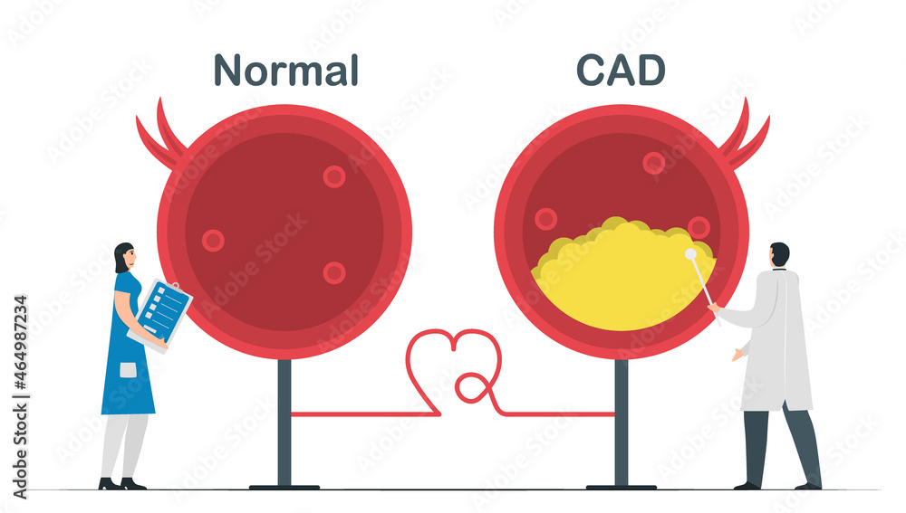 Comparison of Normal heart and Coronary artery disease.Cardiology ...