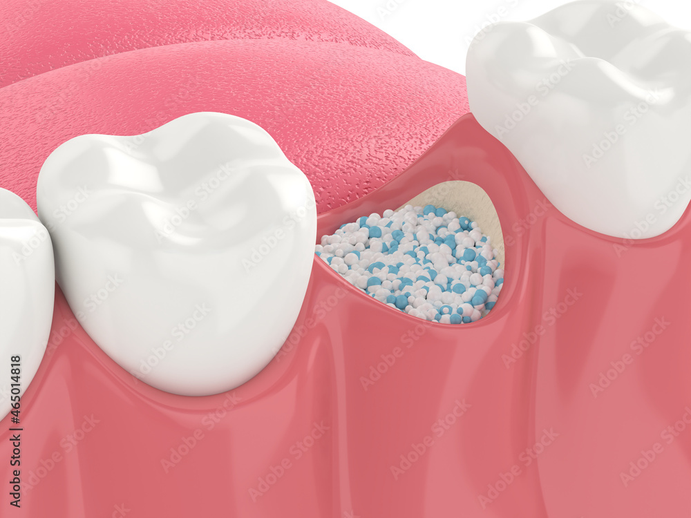 3D render of dental bone grafting with dental bone biomaterial in ...