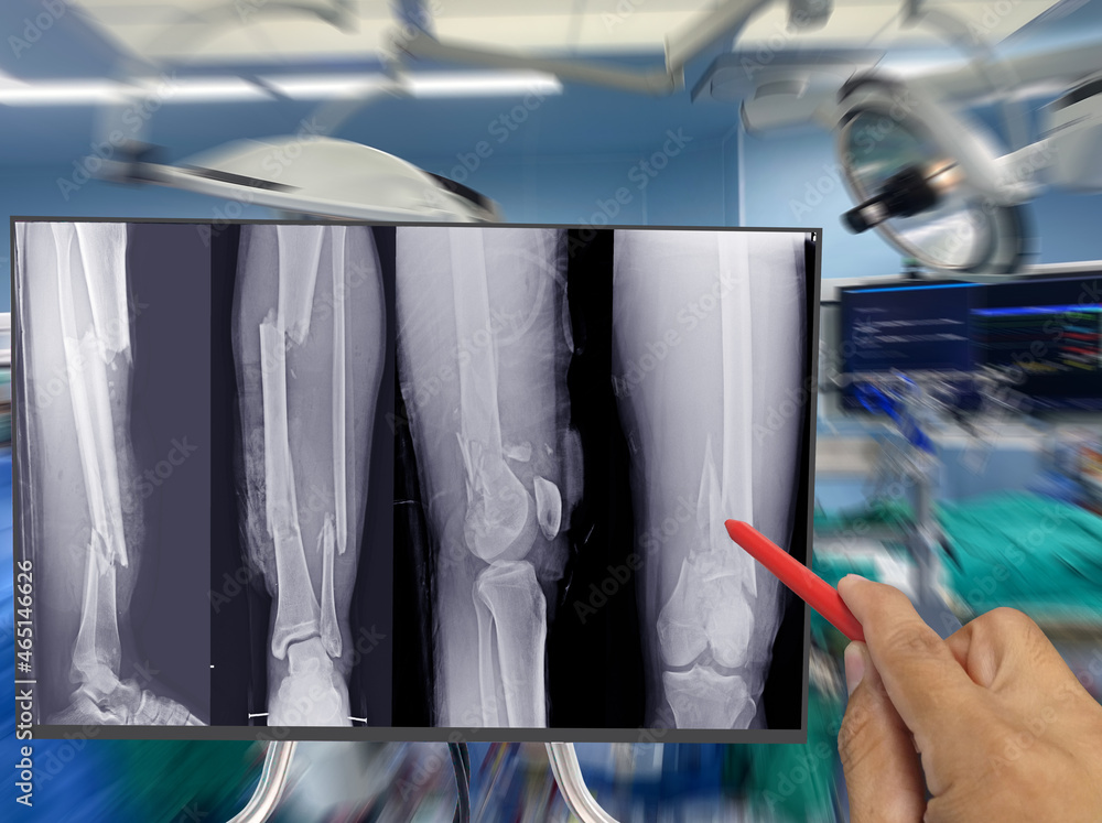 Close up X-ray whole leg bone showing fracture multiple fractures bone ...