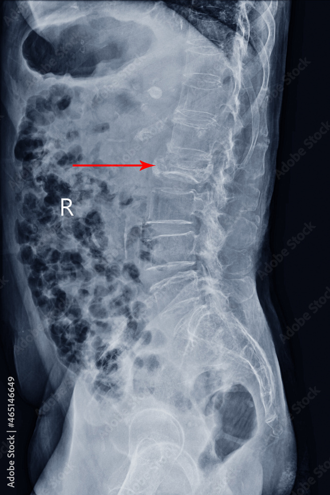 Film X-ray LS-spine Lateral view Showing Burst fracture of L2 vertebral ...