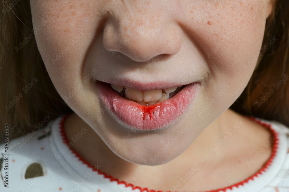 Dry and damaged lips of a girl. Close-up. Lip fissure and bleeding ...