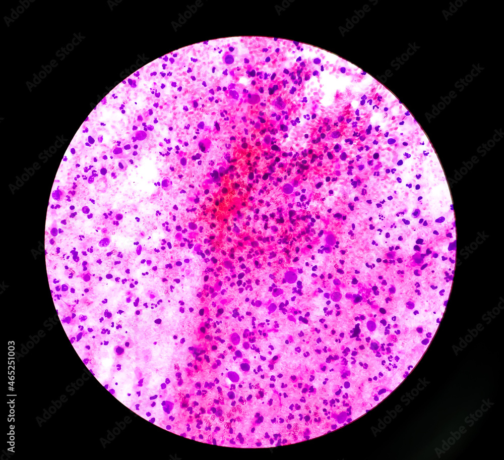Malignant effusion (cancer cells): Pleural fluid cytology of lung ...