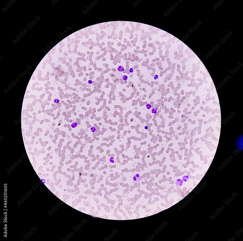 Blood smear Microscopic show increase number of Eosinophils a type of ...