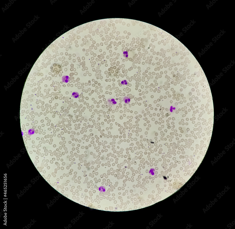 Blood smear Microscopic show increase number of Eosinophils a type of ...