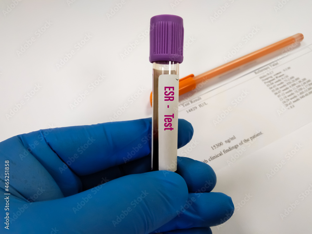 Blood Sample tube for Erythrocytes Sedimentation Rate (ESR) test at ...