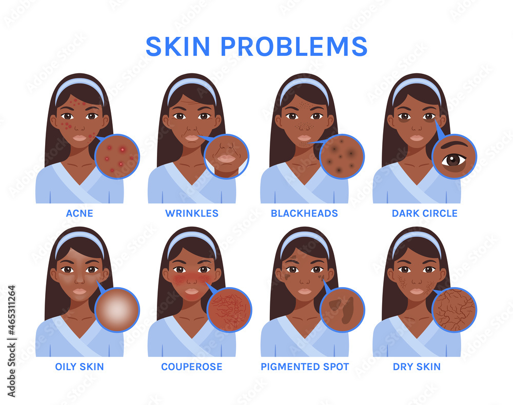 Black African Woman with Skin Problems. Close up of Pimples, Blackheads ...