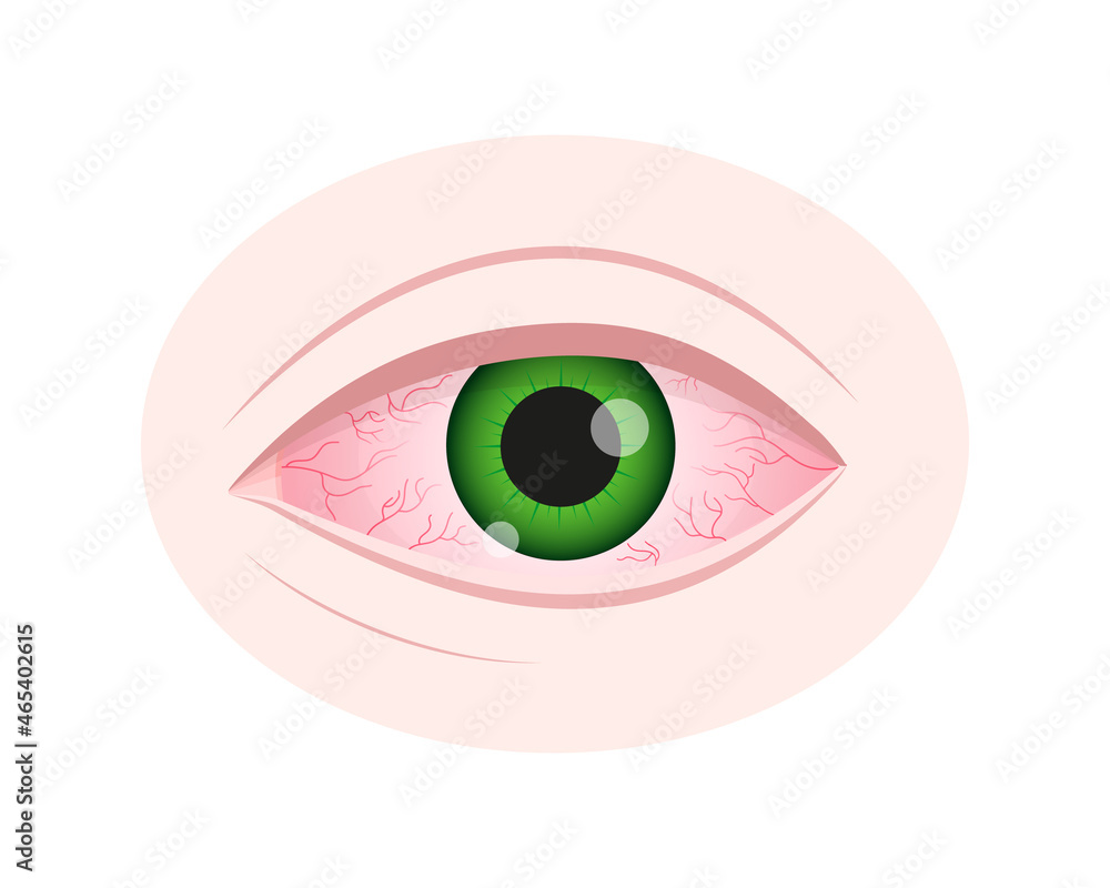 Vecteur Stock Eye irritation. Inflamed bloodshot eyeball with red ...