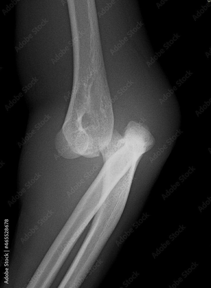 x ray of a elbow dislocation Stock Photo | Adobe Stock