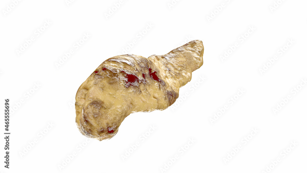 Pancreatitis disease of human pancreas isolated on white. Acute ...