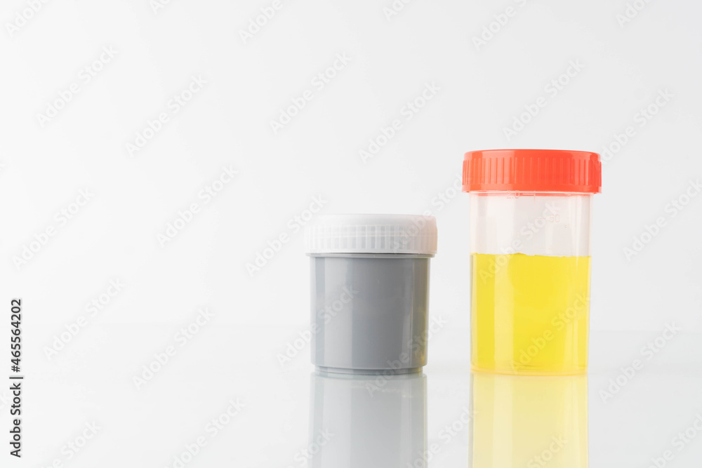 Yellow color urine sample and Stool container specimen bottle for check ...