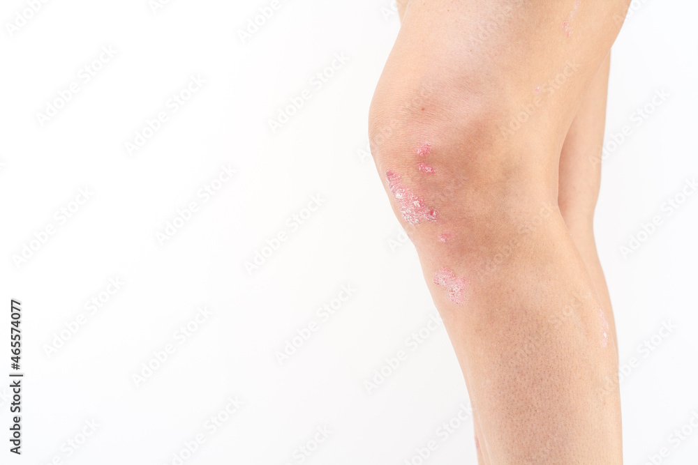 Acute psoriasis on the knees is an autoimmune incurable dermatological ...