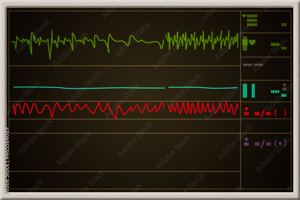 Patient monitor showing vital signs ECG and EKG. Vector illustration ...