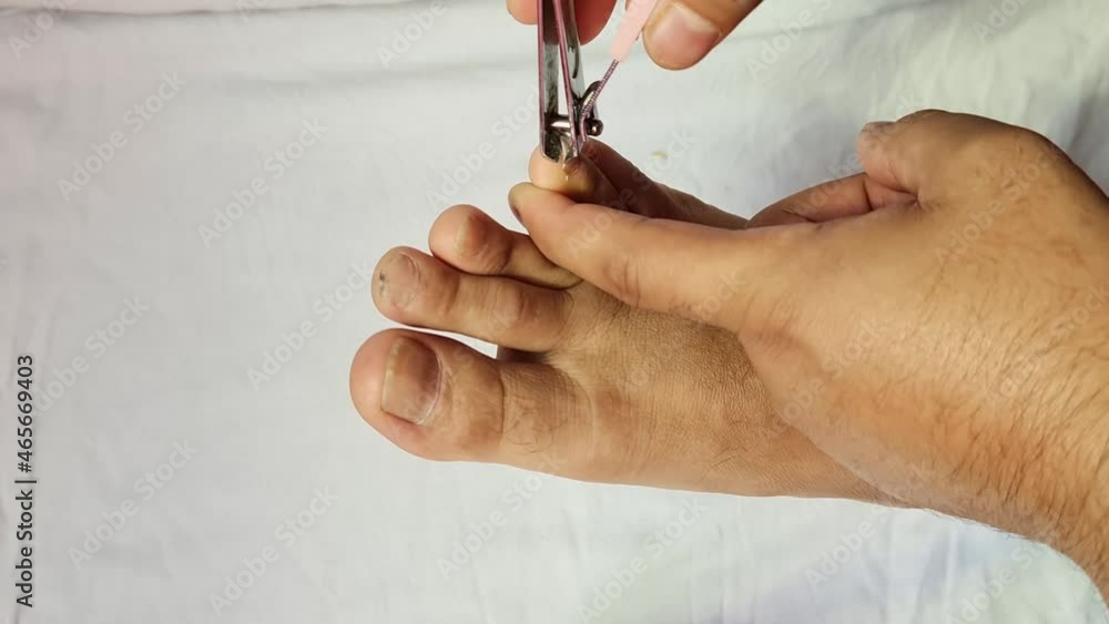 Nail cutting foot with damaged nails because of fungus. Dorsal, callus ...