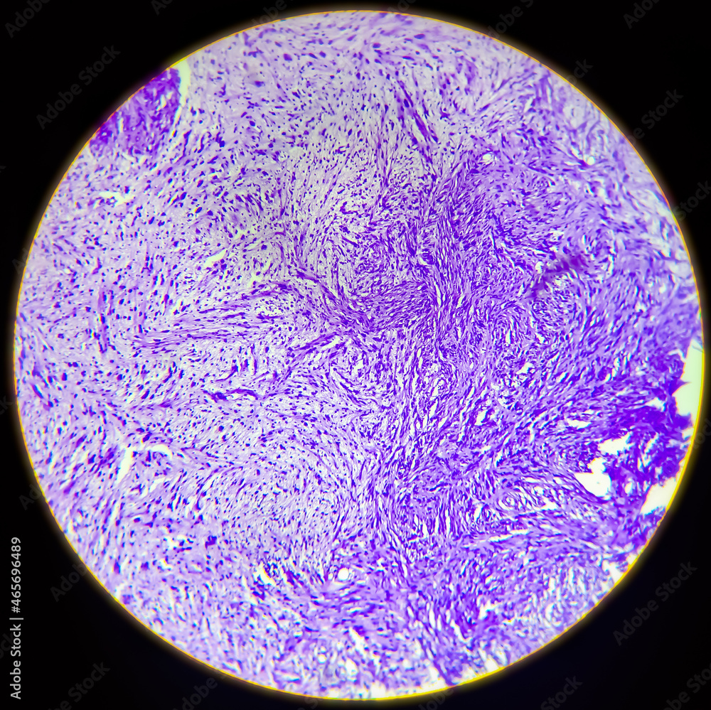 Photomicrograph of a malignant peripheral nerve sheath tumor ...