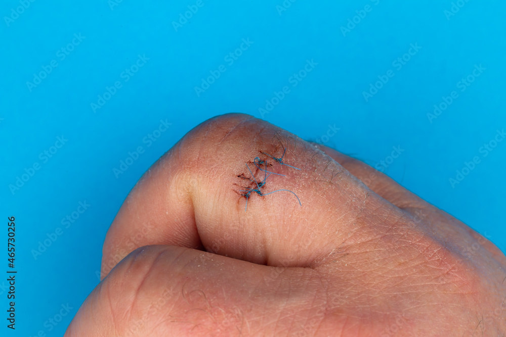 Postoperative sutures on the finger of the hand.. Stitches on the ...