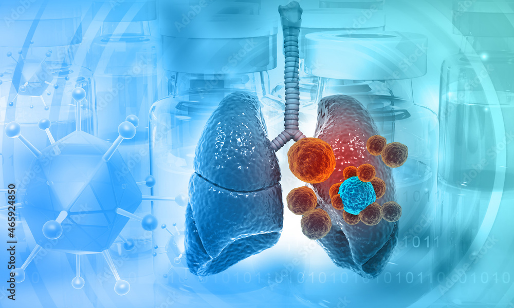 Human lungs cancer. lungs anatomy diagram. 3d illustration. Stock ...