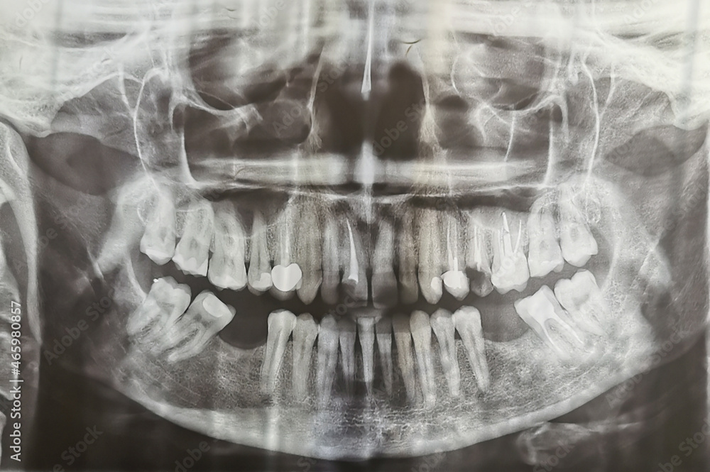 Dental radiography. Digital x-ray teeth scan of adult female. Human ...