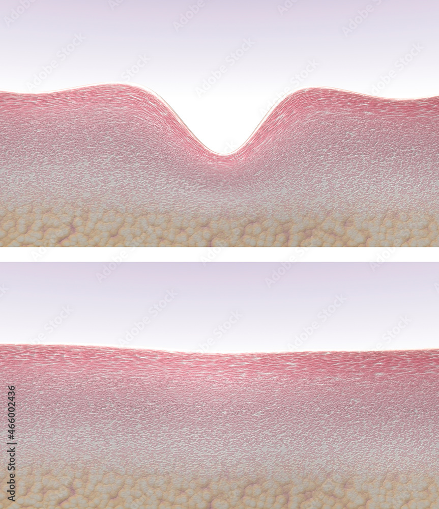 Skin before and after wrinkle reduction and collagen renovation ...