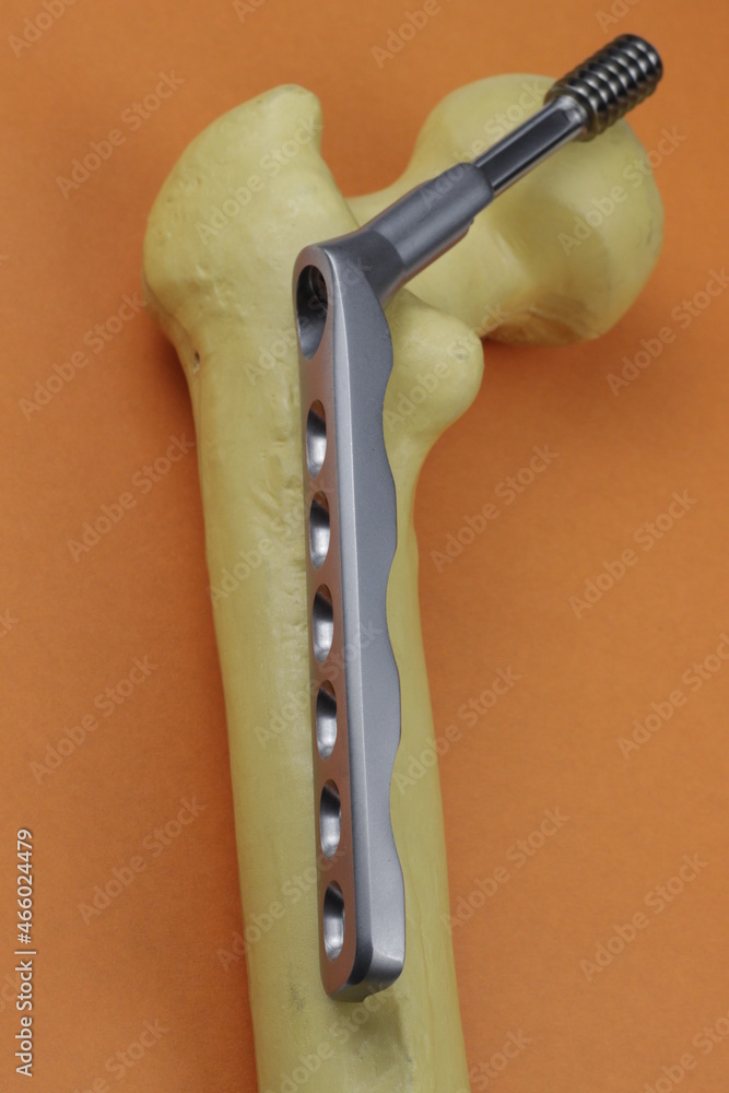 Surgical plates for osteosynthesis in case of hip fractures Stock Photo ...