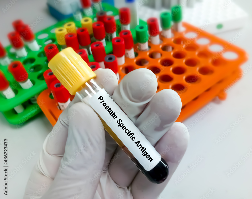 Blood sample for Prostate Specific Antigen (PSA) test, diagnosis for ...