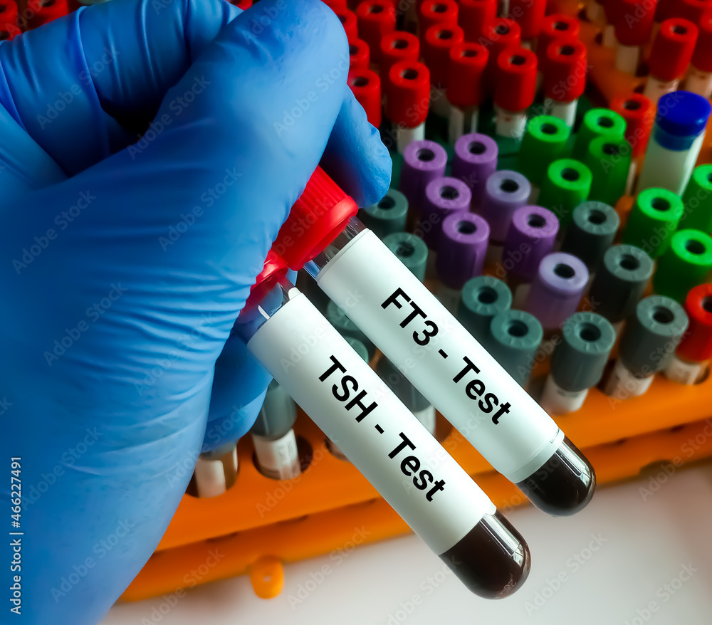 Blood sample for FT3 and TSH test. Diagnosis for thyroid disease foto ...