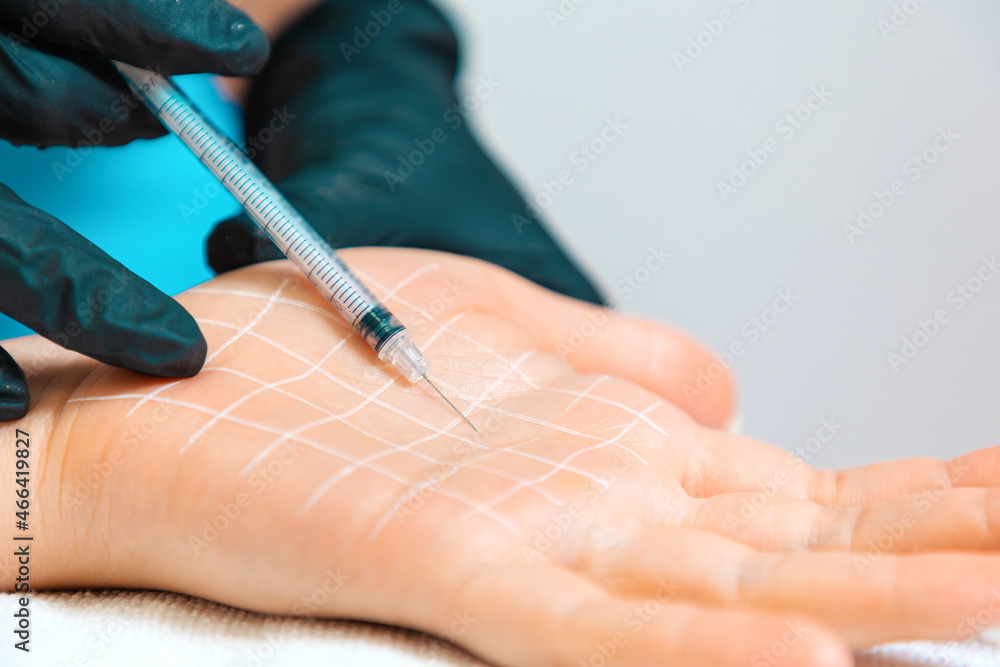 Protection from perspiring, hyperhidrosis. Doctor makes injections of ...