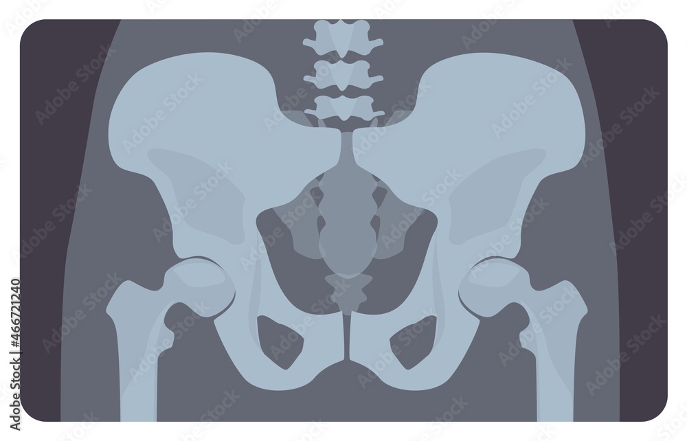 Anterior radiograph of human pelvis or hip bone with lumbar part. X-ray ...