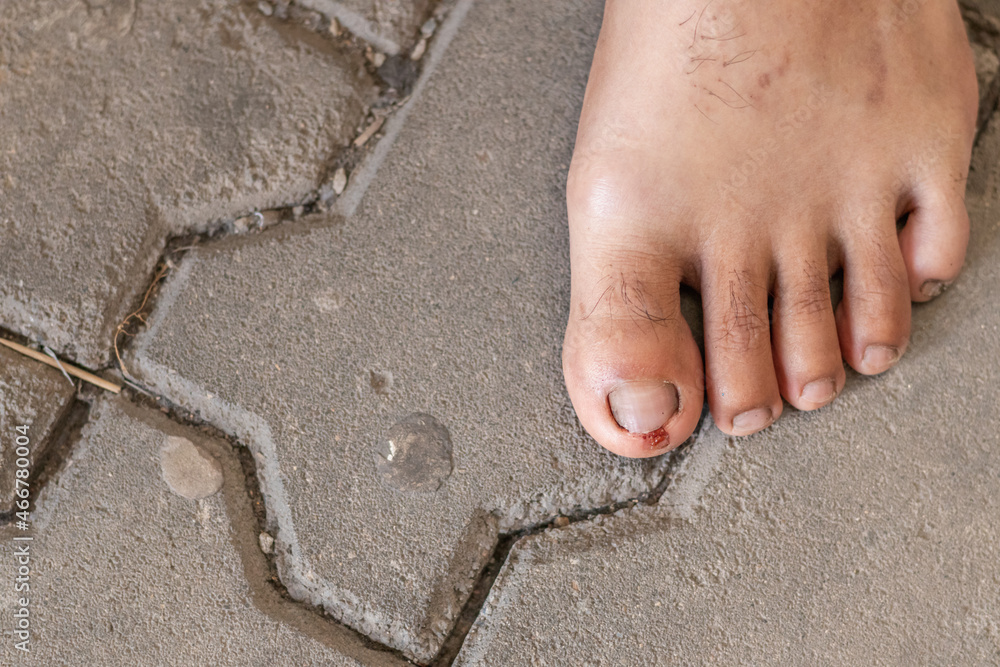 Fotka „Toe injuries are caused by carelessness while walking, causing ...