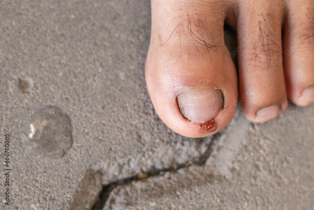 Toe injuries are caused by carelessness while walking, causing the toes ...