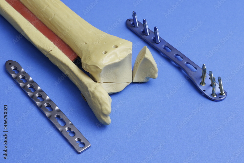 Surgical plates and instruments for osteosynthesis of bone fractures ...