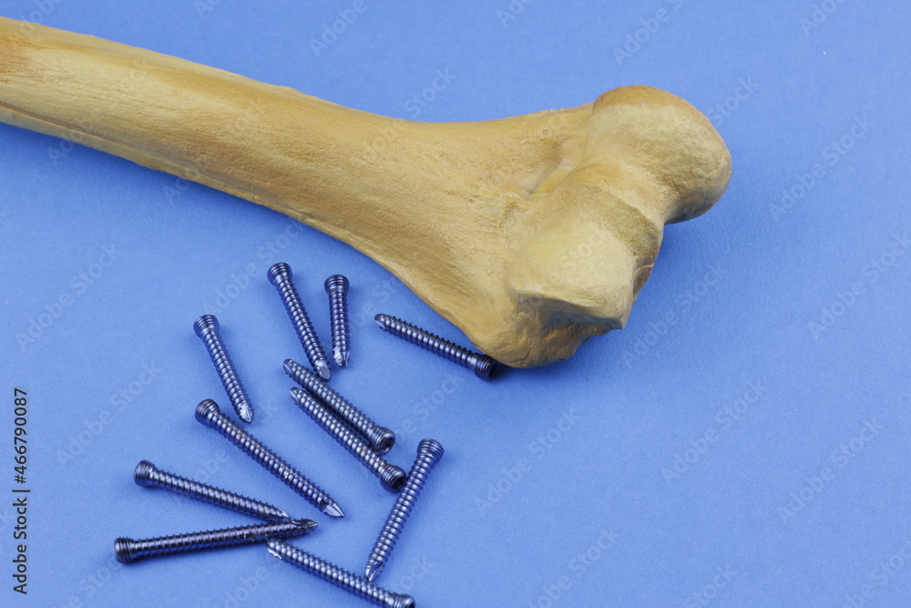 Surgical plates and instruments for osteosynthesis of bone fractures ...