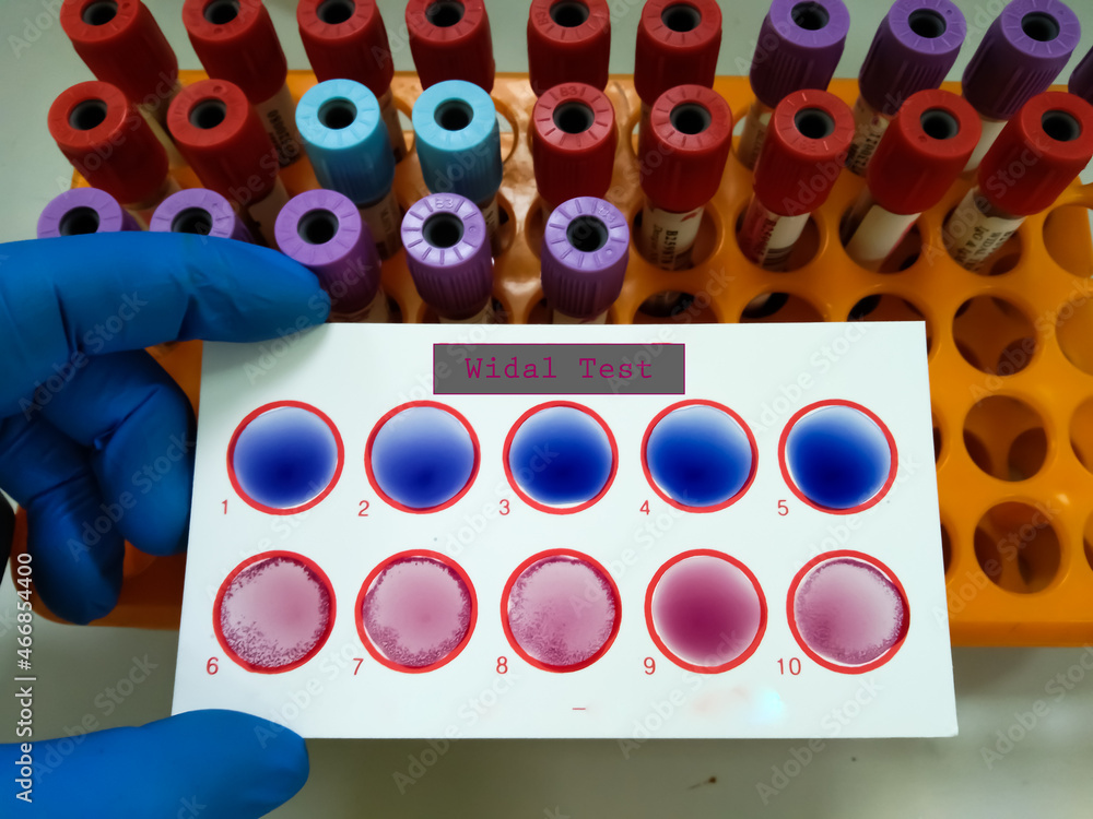 Widal test by agglutination method at plate isolated on white ...