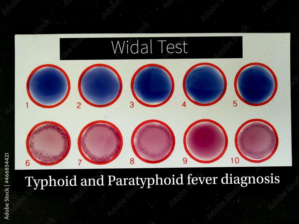 Widal test by agglutination method at plate isolated on white ...