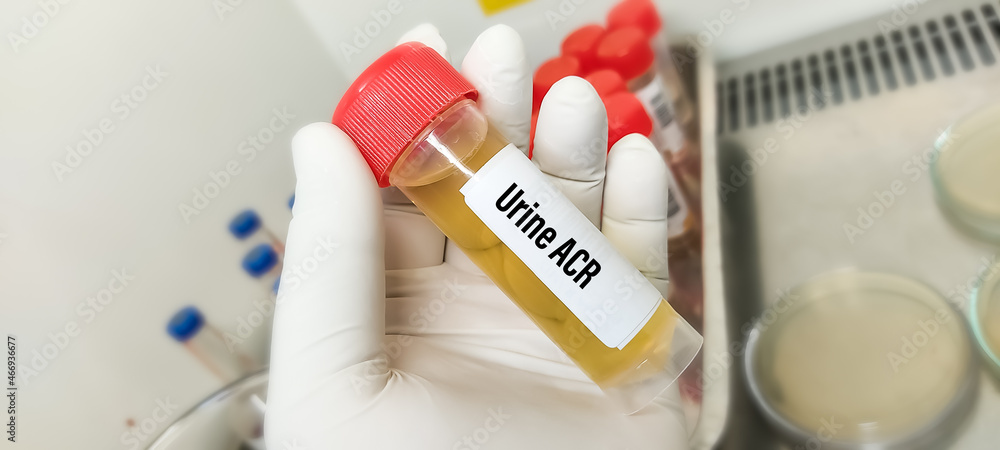 Urine Sample for Urine ACR (Albumin creatinine Ratio) test, Diagnosis ...