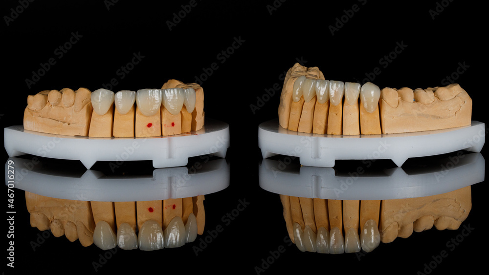 Two models with ceramic dental veneers for upper and lower cutters ...