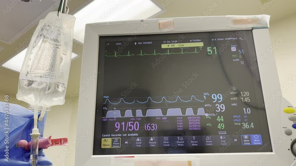 Operating Room Vitals Monitor on Anesthesia Machine Stock ビデオ | Adobe Stock