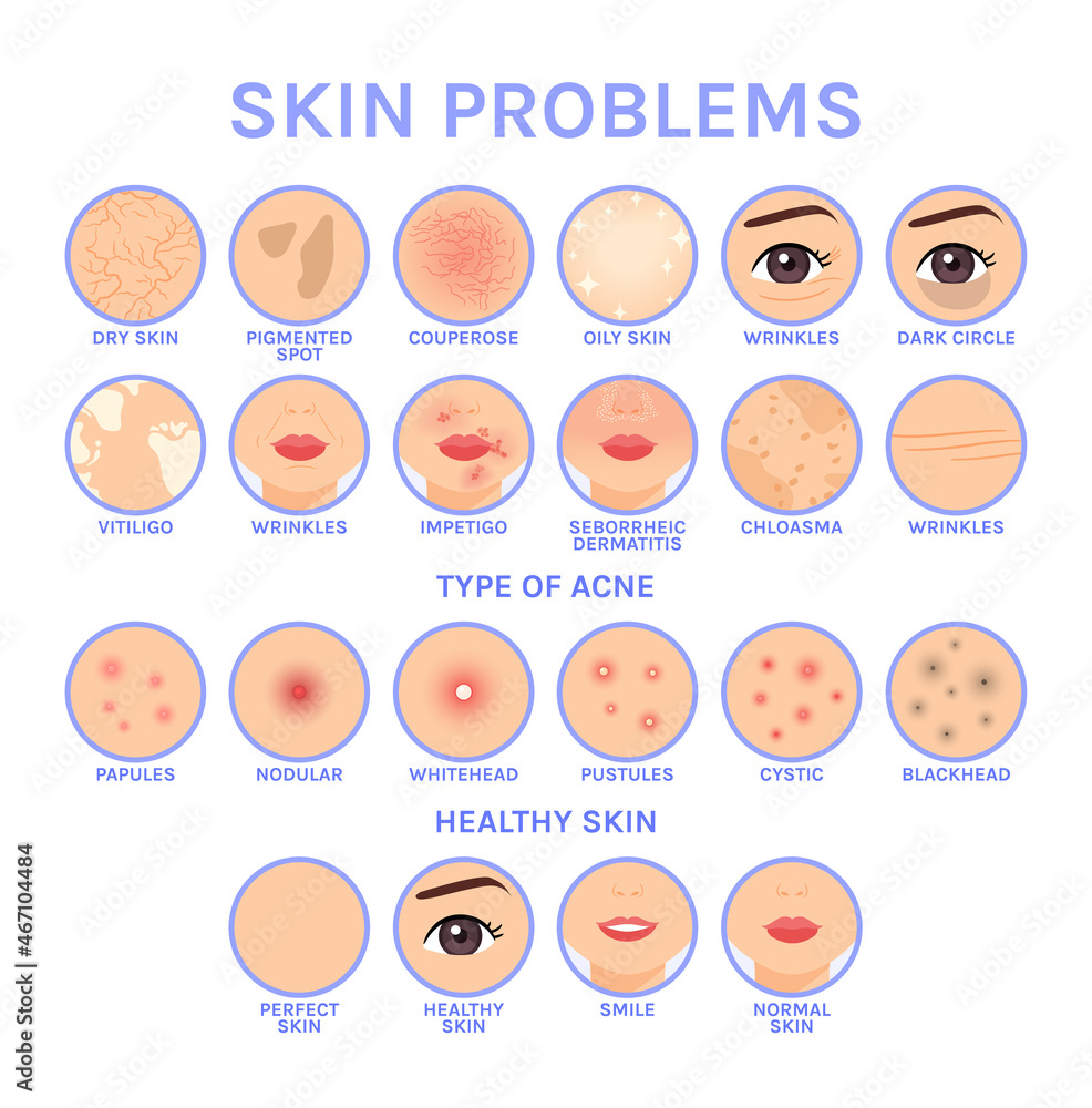 Skin Problems. Set of Icons for Different Skin Diseases of Face. Before ...