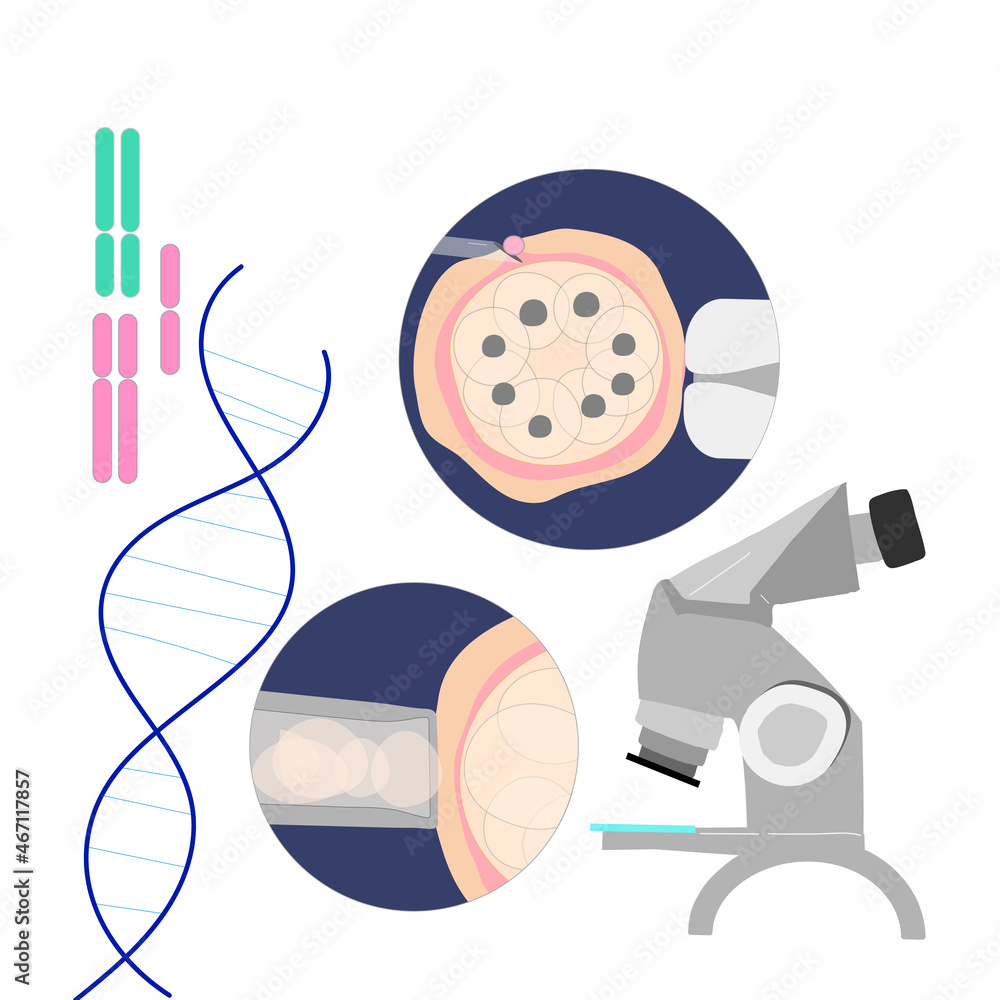 Vector colored illustration of PGD preimplantation genetic screening of ...