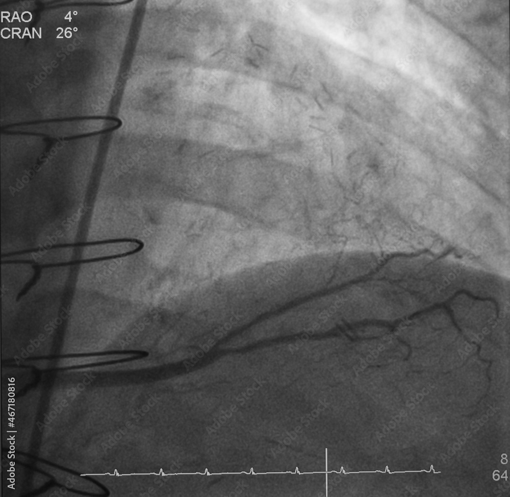 Coronary angiogram (CAG) was performed saphenous vein graft (SVG) to ...