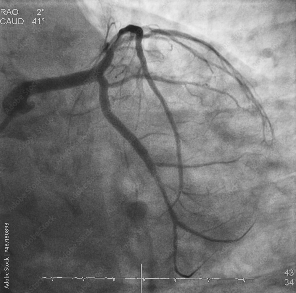 Coronary angiogram (CAG) was performed successful percutaneous coronary ...