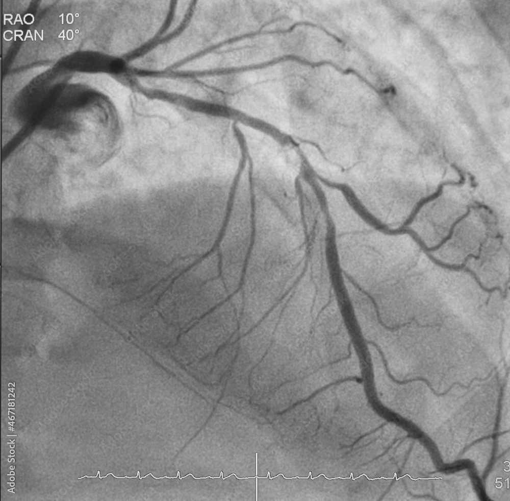 Foto de Coronary angiogram (CAG) was performed left anterior descending ...