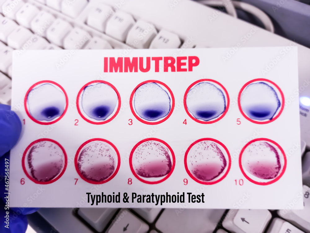 Widal test by agglutination method at plate, to diagnosis Typhoid and ...