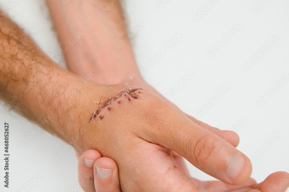 Suture wound on hand,Pain of accident concept Stock Photo | Adobe Stock